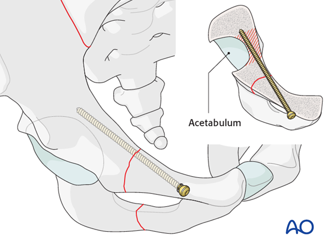 Orif Pubic Ramus Screw For Pubic Ramus Fractures