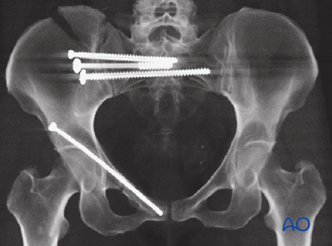 Orif Pubic Ramus Screw For Pubic Ramus Fractures