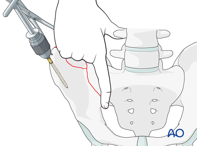 ORIF - ilium for Iliac fractures