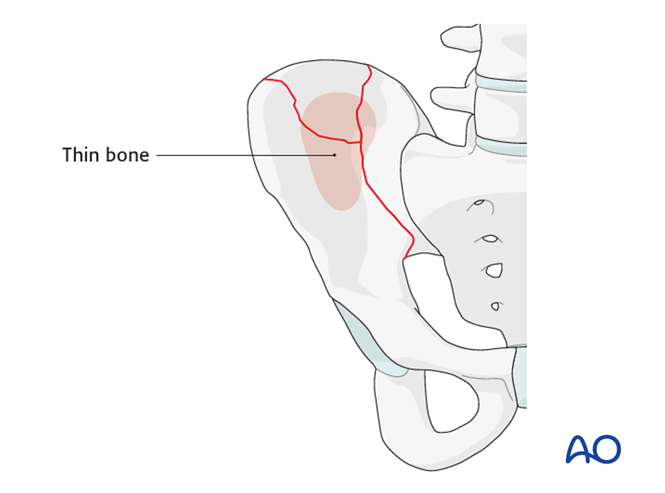 ORIF - ilium for Iliac fractures