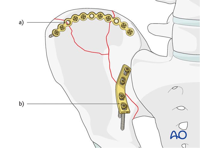 ORIF - ilium for Iliac fractures