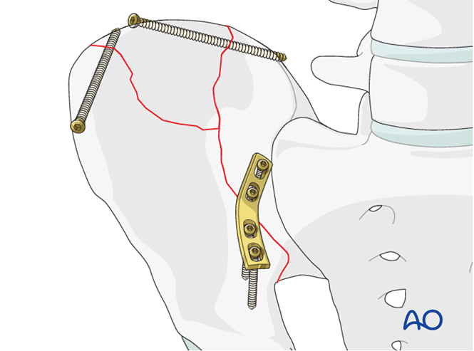 Operative treatment for Incomplete disruption of posterior arch ...