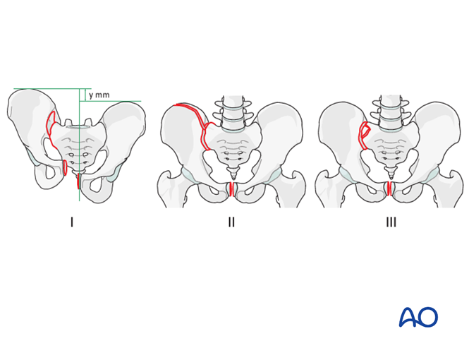 ORIF - Anterior SI fracture fixation for SI-joint fractures