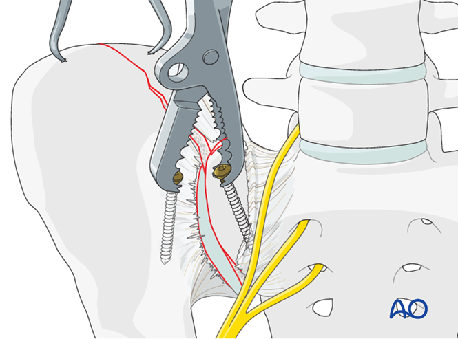 ORIF - Anterior SI fracture fixation for SI-joint fractures