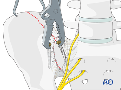 ORIF - Anterior SI fracture fixation for SI-joint fractures