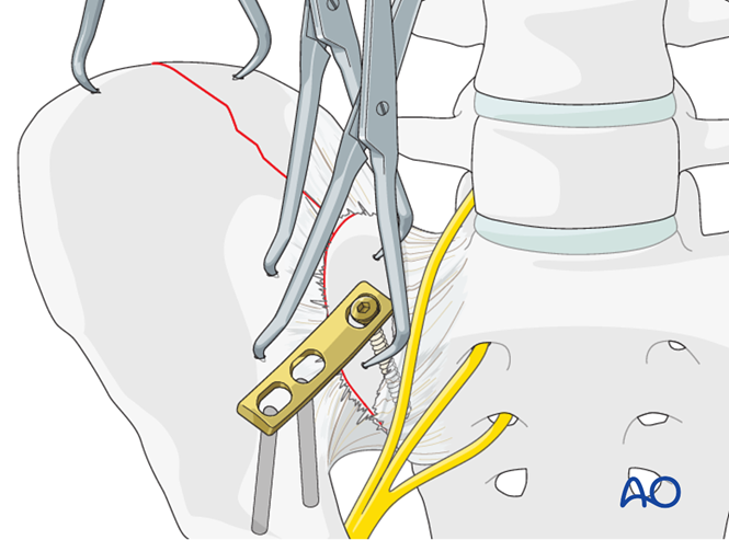 ORIF - Anterior SI fracture fixation for SI-joint fractures