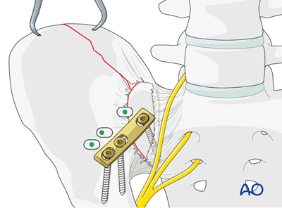 ORIF - Anterior SI fracture fixation for SI-joint fractures