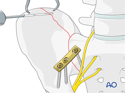ORIF - Anterior SI fracture fixation for SI-joint fractures