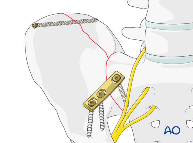 ORIF - Anterior SI fracture fixation for SI-joint fractures