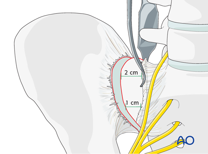 ORIF - Anterior fixation SI Joint for SI-joint fractures