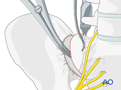 ORIF - Anterior fixation SI Joint for SI-joint fractures