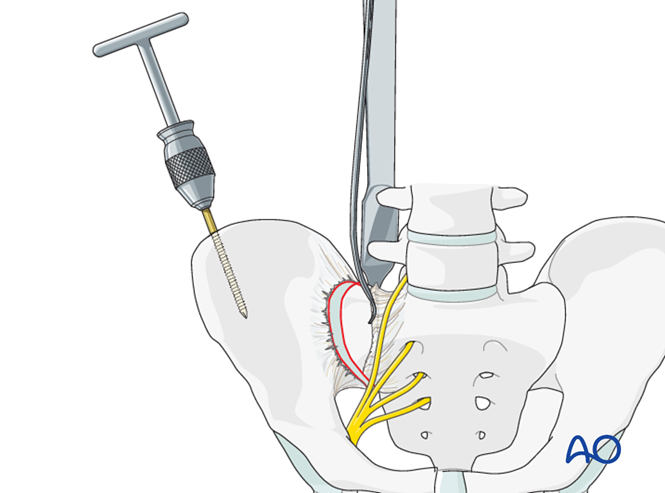 ORIF - Anterior fixation SI Joint for SI-joint fractures