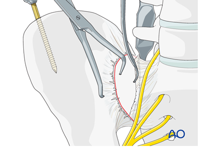 ORIF - Anterior fixation SI Joint for SI-joint fractures