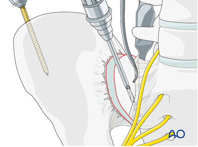 ORIF - Anterior fixation SI Joint for SI-joint fractures