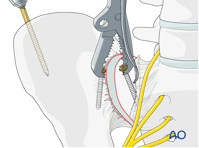 ORIF - Anterior fixation SI Joint for SI-joint fractures