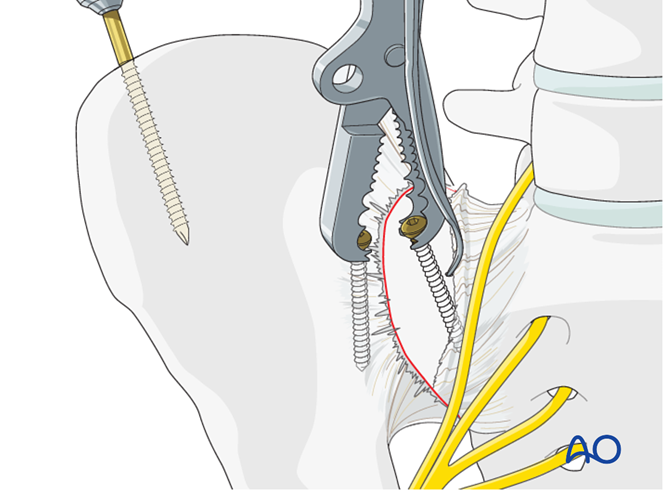 ORIF - Anterior fixation SI Joint for SI-joint fractures