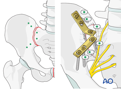 ORIF - Anterior fixation SI Joint for SI-joint fractures