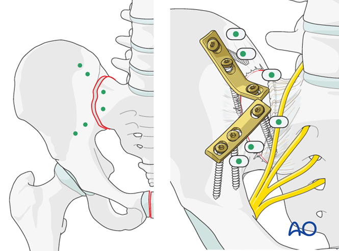 ORIF - Anterior fixation SI Joint for SI-joint fractures