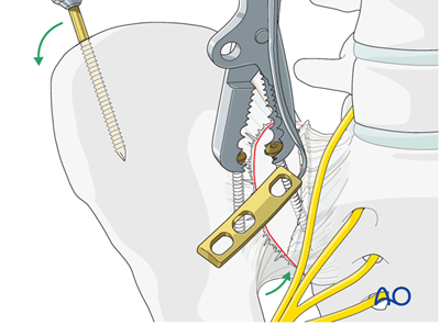 ORIF - Anterior fixation SI Joint for SI-joint fractures