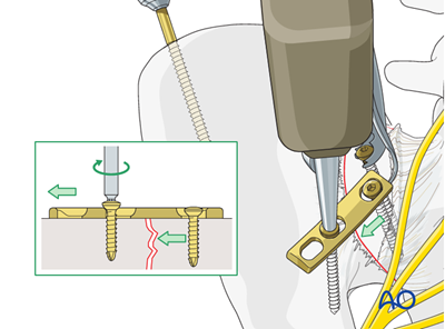 ORIF - Anterior fixation SI Joint for SI-joint fractures