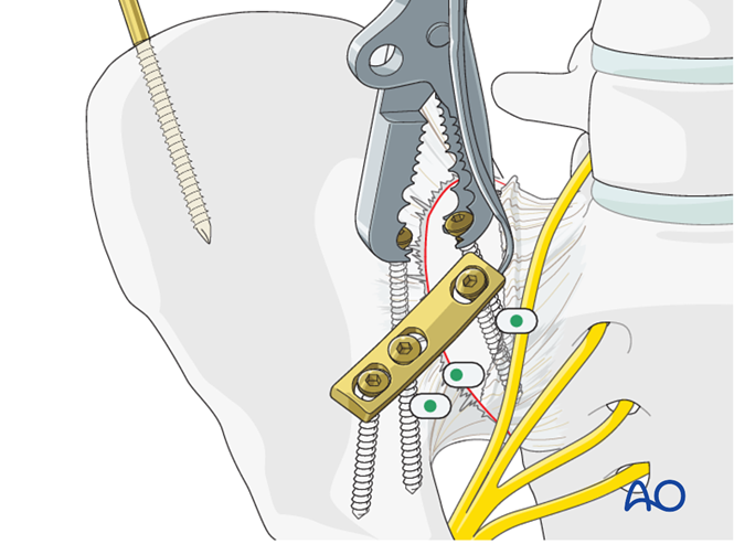 ORIF - Anterior fixation SI Joint for SI-joint fractures
