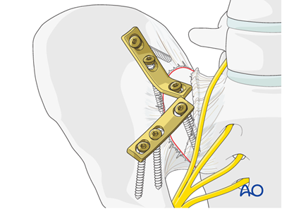 ORIF - Anterior fixation SI Joint for SI-joint fractures