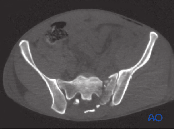 ORIF - Sacrum for Sacral fractures