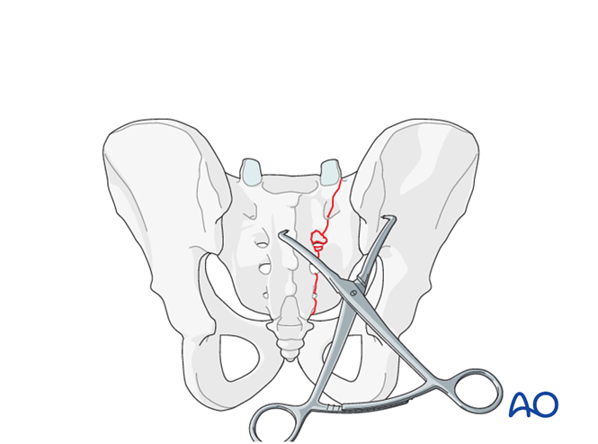 ORIF - Sacrum for Sacral fractures