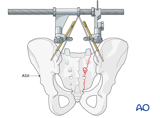 ORIF - Sacrum for Sacral fractures