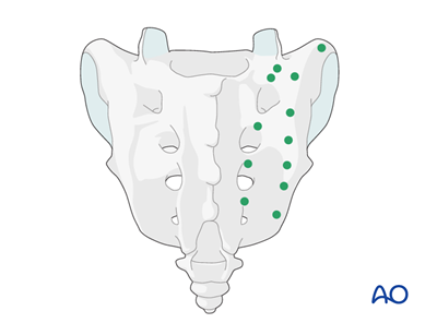 ORIF - Sacrum for Sacral fractures
