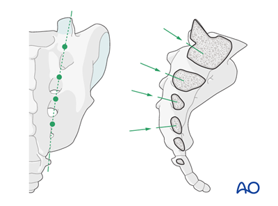ORIF - Sacrum for Sacral fractures
