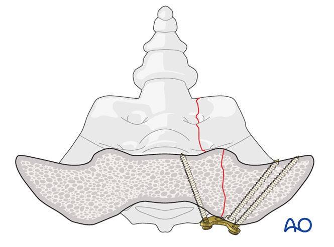 ORIF - Sacrum for Sacral fractures