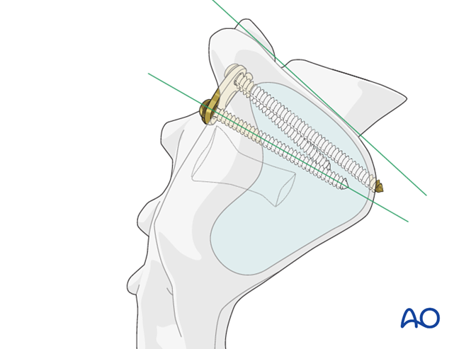 ORIF - Sacrum for Sacral fractures