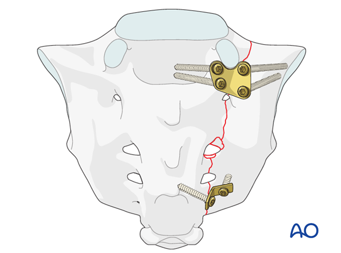 Operative treatment for Unilateral complete disruption of posterior ...