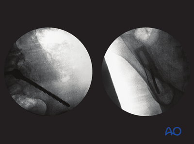 Triangular osteosynthesis