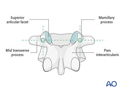 Triangular osteosynthesis