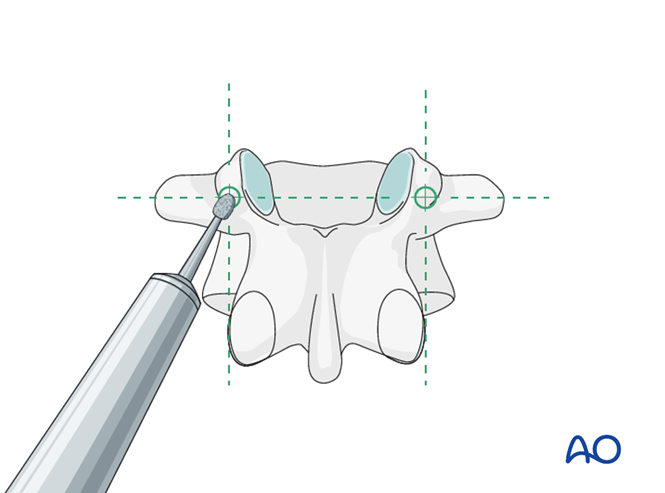Triangular osteosynthesis