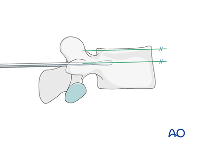 Triangular osteosynthesis