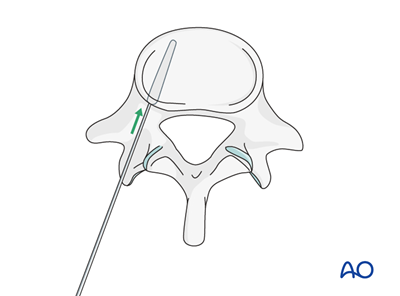 Triangular osteosynthesis