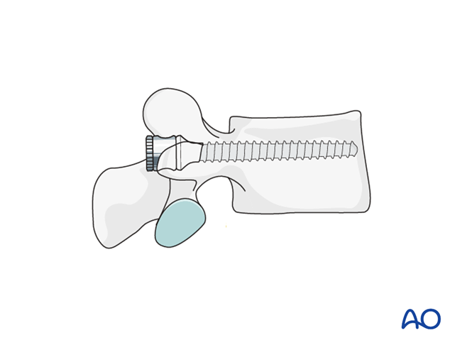 Triangular osteosynthesis