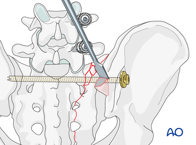 Triangular osteosynthesis