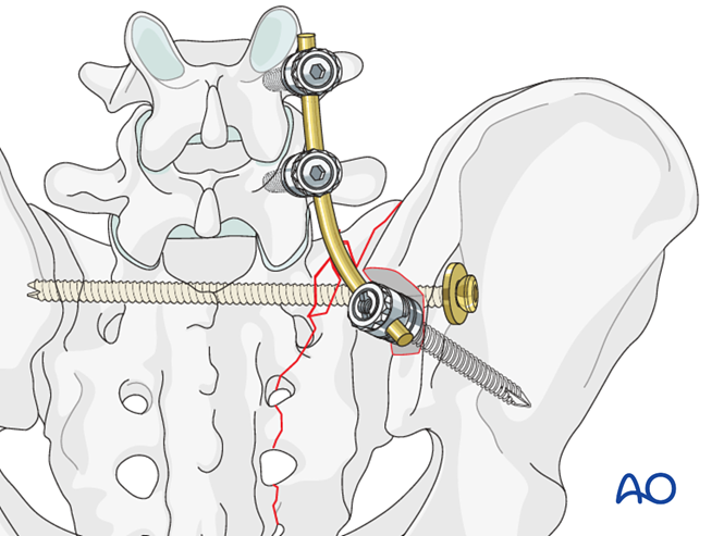 ORIF - Triangular osteosynthesis for Sacral fractures