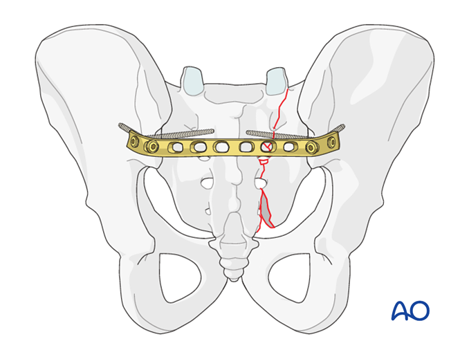 ORIF - Ilioiliac plate for Sacral fractures