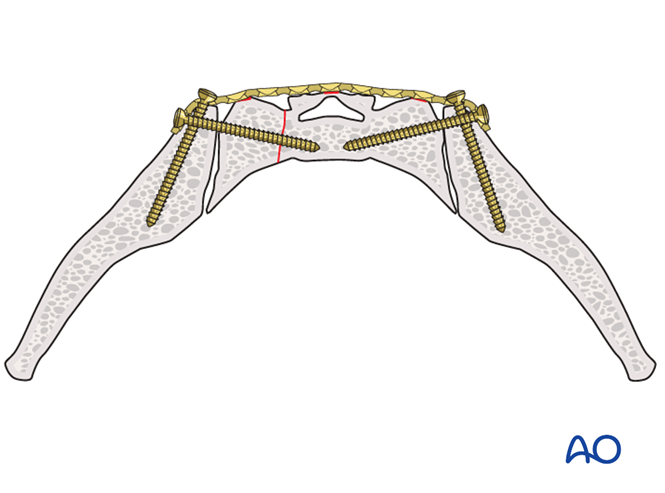 ORIF - Ilioiliac plate for Sacral fractures