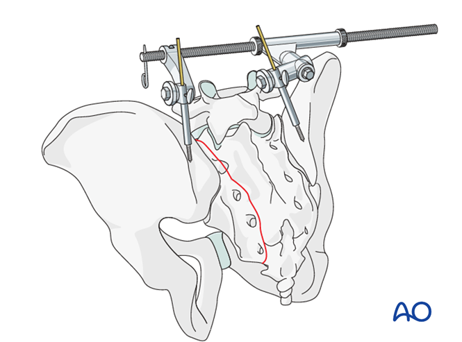 ORIF - Spinopelvic fixation for Sacral fractures