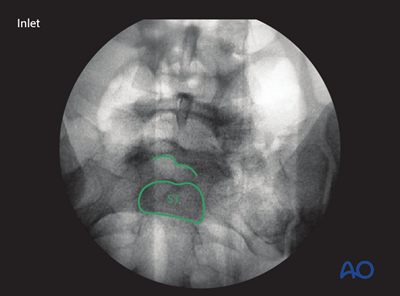Iliosacral screw for SI joint