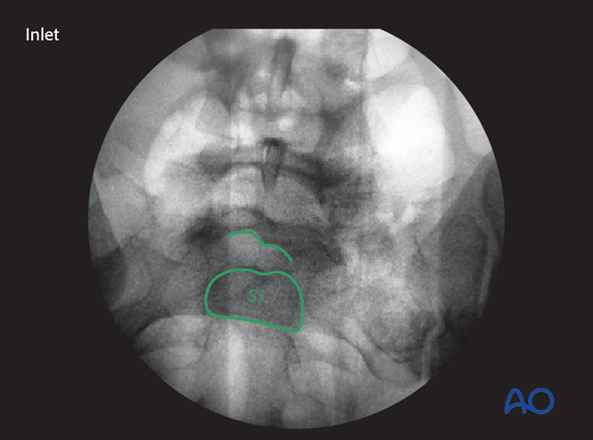 Iliosacral screw for SI joint