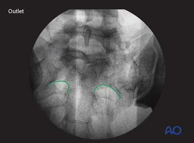 Iliosacral screw for sacrum