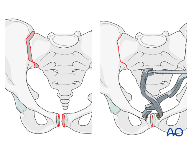 MIO - Iliosacral screw for sacrum for SI-joint fractures