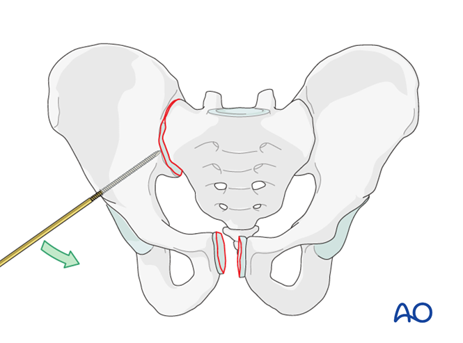 Iliosacral screw for SI joint